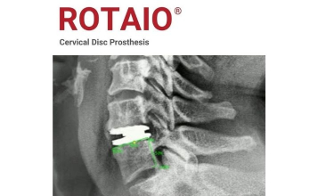 SIGNUS passion: setting new standards in spinal surgery
