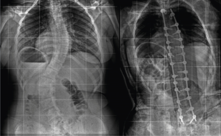 SIGNUS passion: setting new standards in spinal surgery