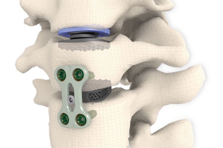 cervical, disc prosthesis, motion preservation