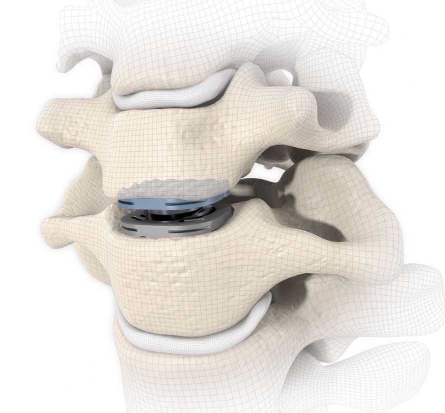 cervical, disc prosthesis, motion preservation