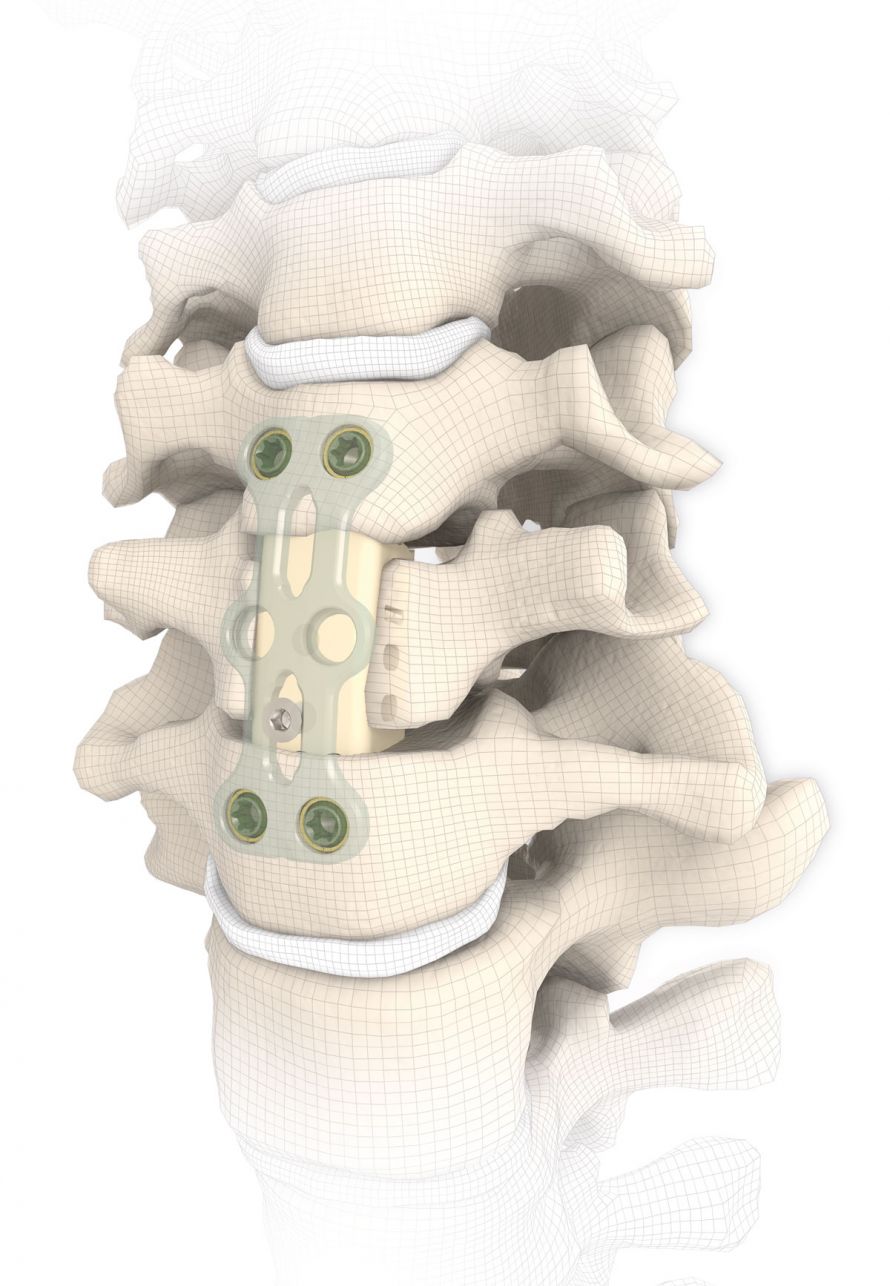 cervical, vertebral body replacement, anterior, corpectomy, lordosis