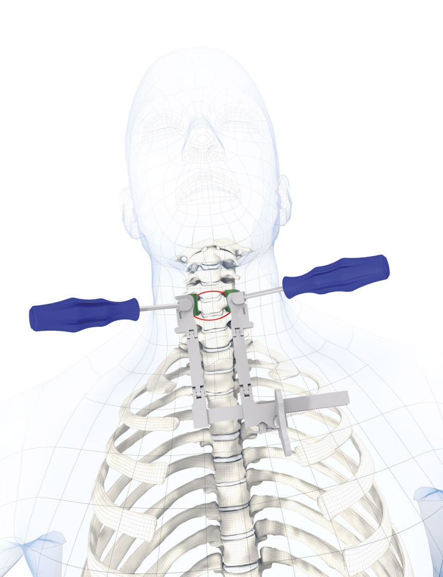 cervical, retractor system, ventral, distractor, blades