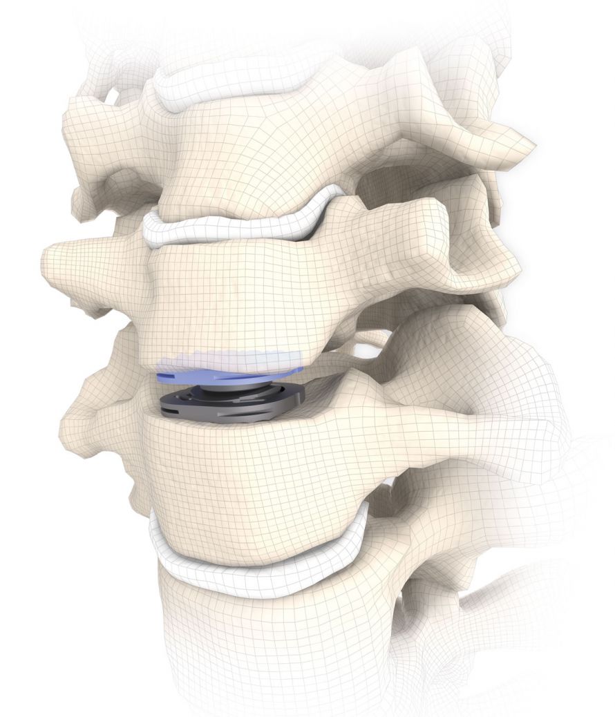 cervical, disc prosthesis, motion preservation