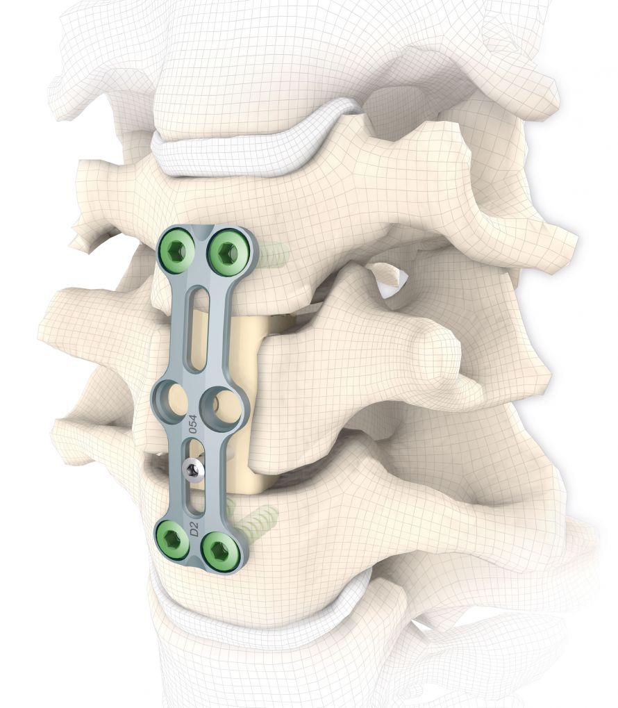 anterior, cervical, plate, screw, mono- and bicortical
