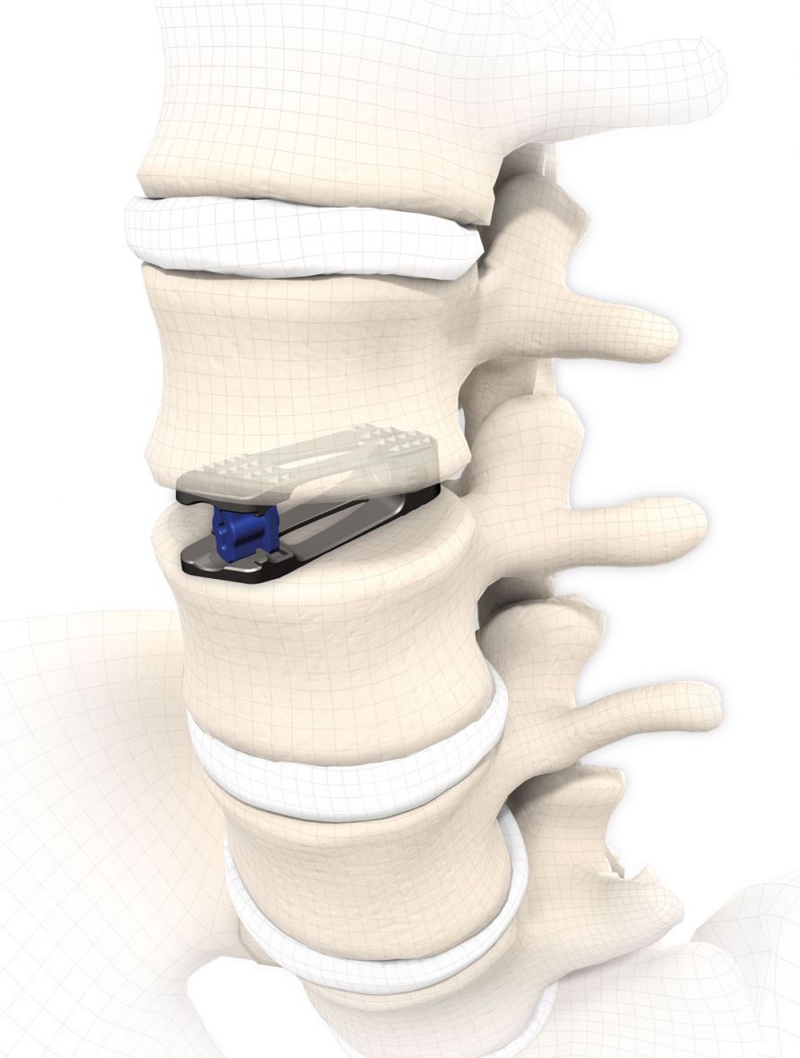 lumbar, disc replacement, fusion, TLIF